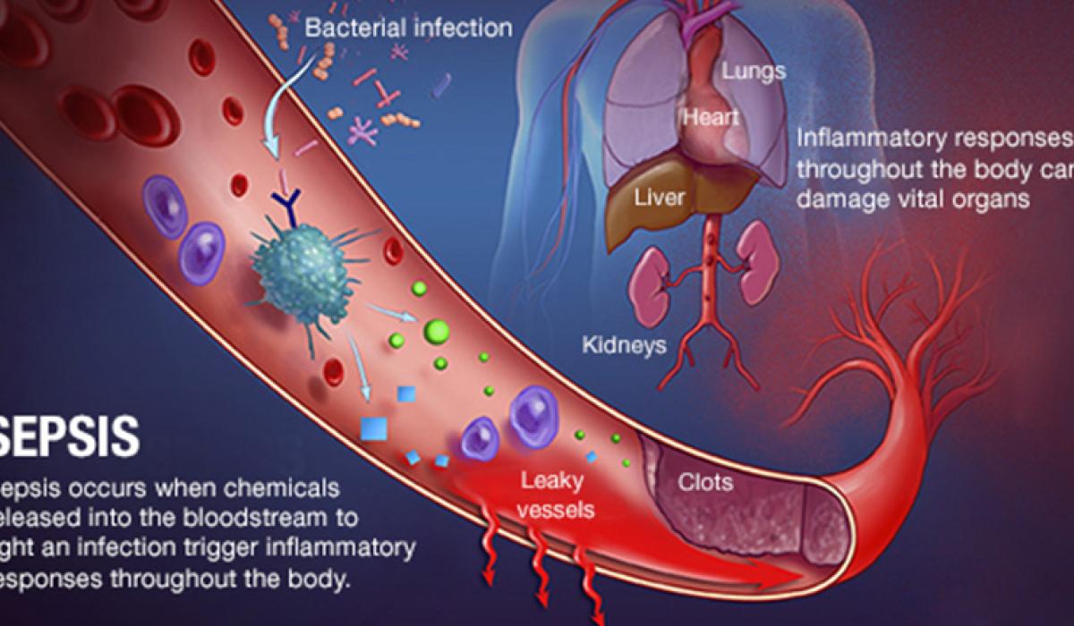 HSE on importance of knowing the signs and symptoms of Sepsis - Donegal ...