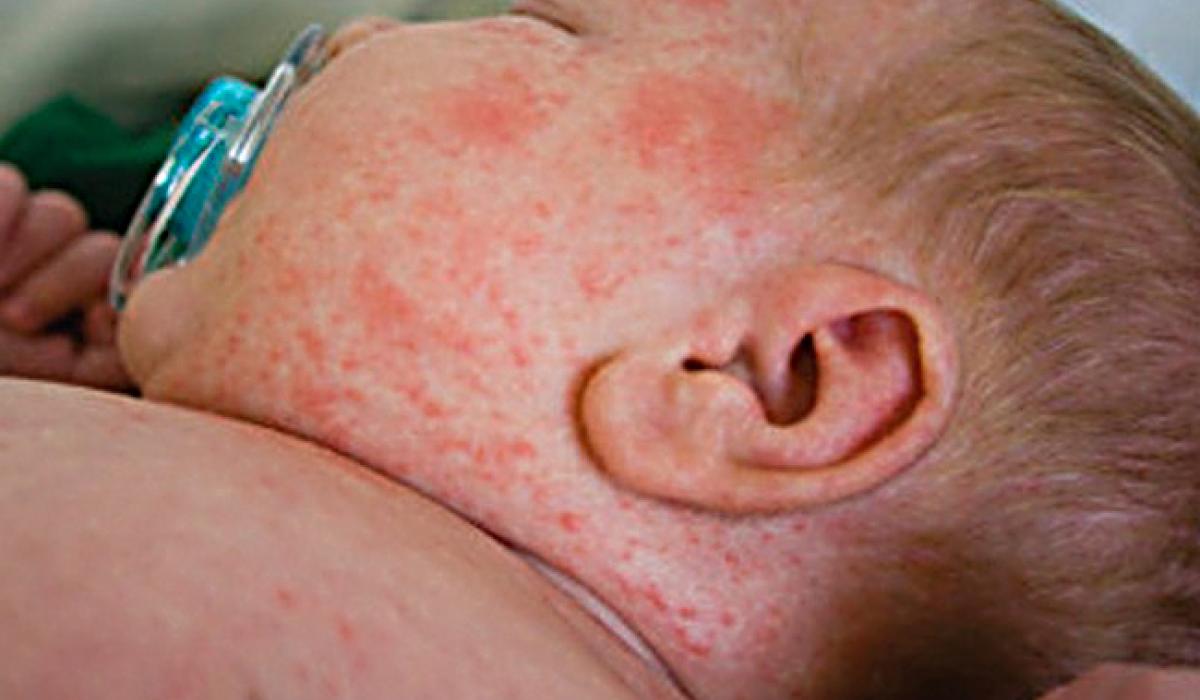 Parents urged to ensure children and young people are vaccinated against measles - Donegal Live